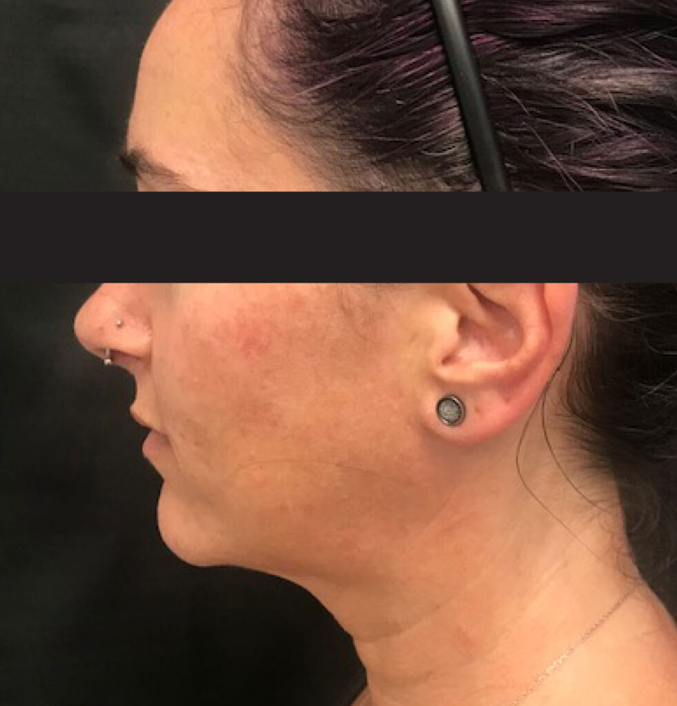 Thread Lift | Non-surgical Face & Neck Lift | Santa Cruz